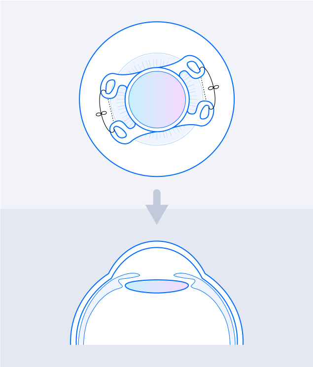 하이안과 | 모든 눈 수술은, 하이안과